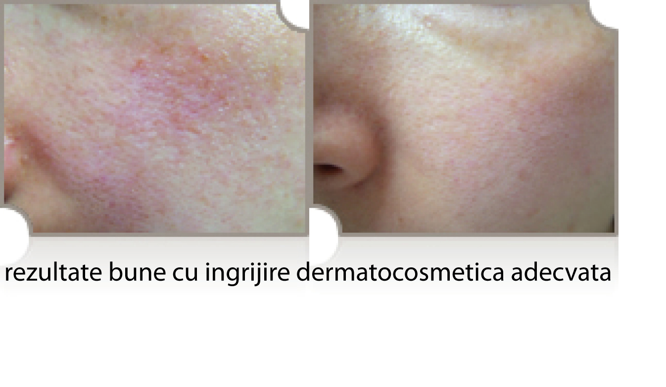 Telangiectazie. Cuperoza. Dermatita Rozacee.