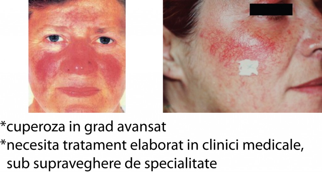 Telangiectazie. Cuperoza. Dermatita Rozacee.